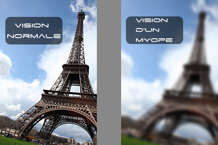 Presbyte, myope, astigmate, hypermétrope : quelle différence